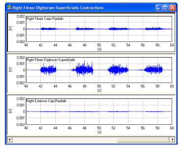 What is EMG sensor, Myoware and How to use with Arduino? - Latest News ...